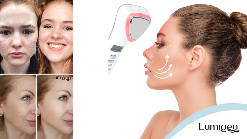 Lumigen, hot and cold anti-aging laser,reviews and opinions